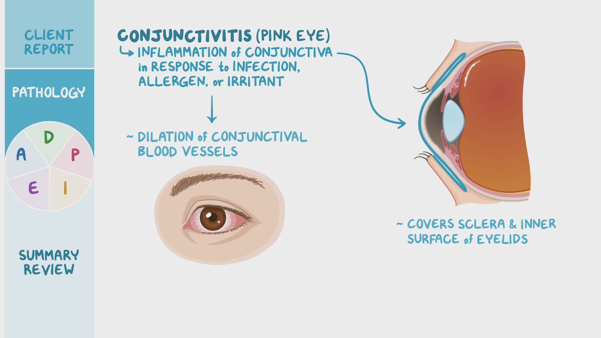 Video: Conjunctivitis: Nursing process (ADPIE) | Osmosis