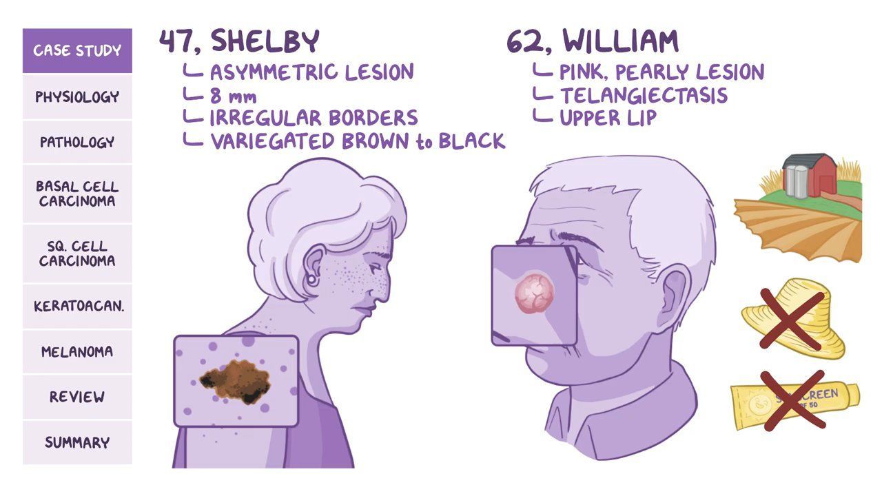 Video: Skin cancer: Pathology review | Osmosis