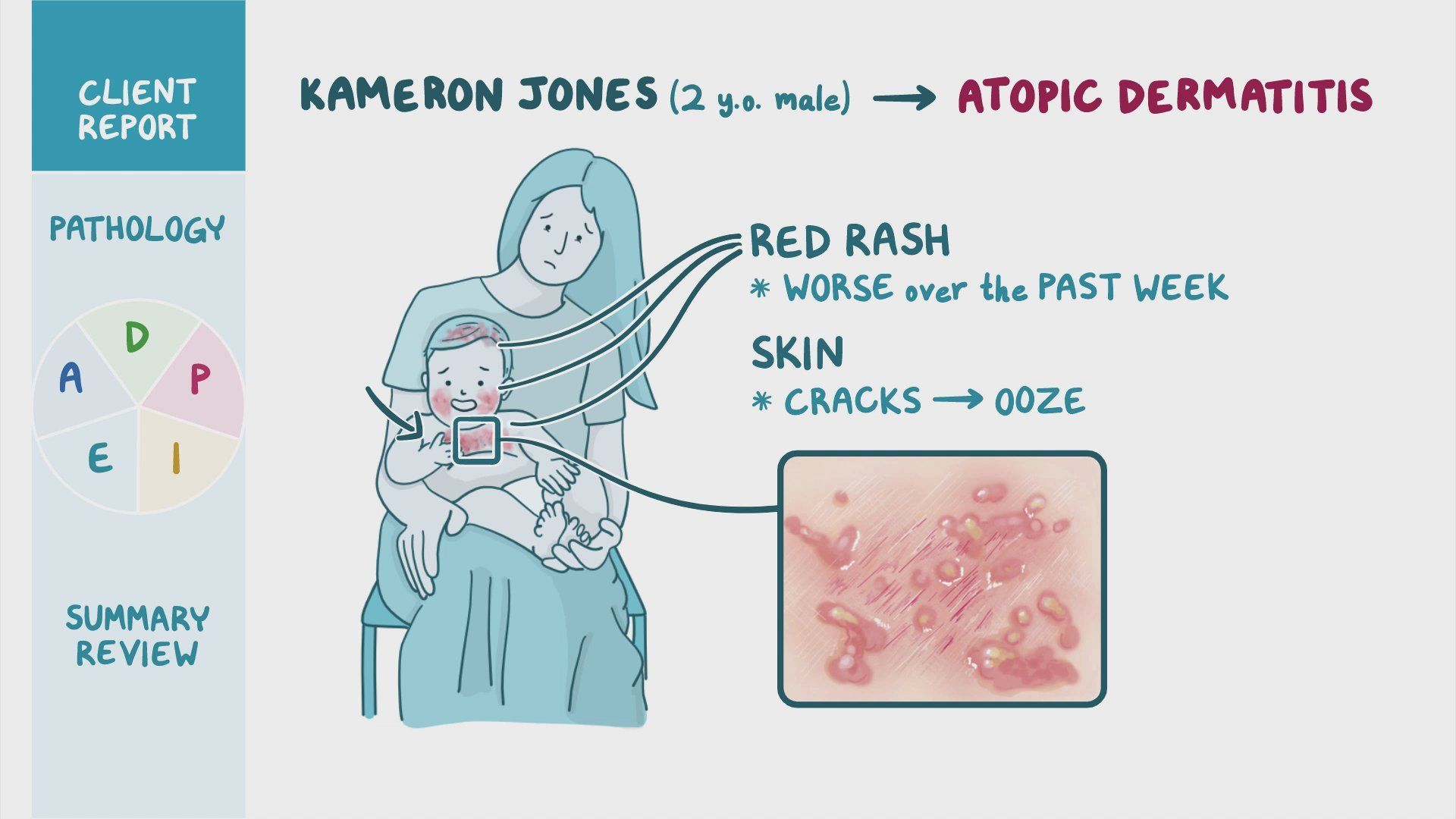 Atopic dermatitis: Nursing Process (ADPIE) - Osmosis