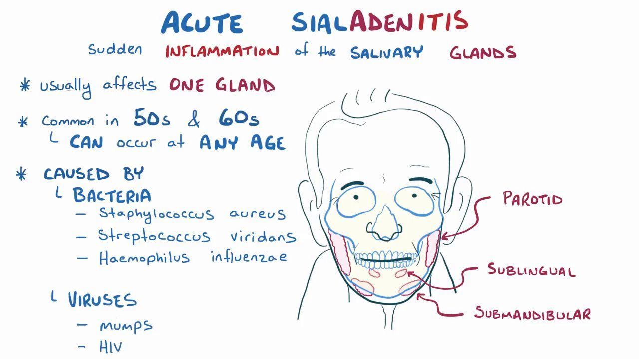 Video Sialadenitis Osmosis Video Sialadenitis Osmosis