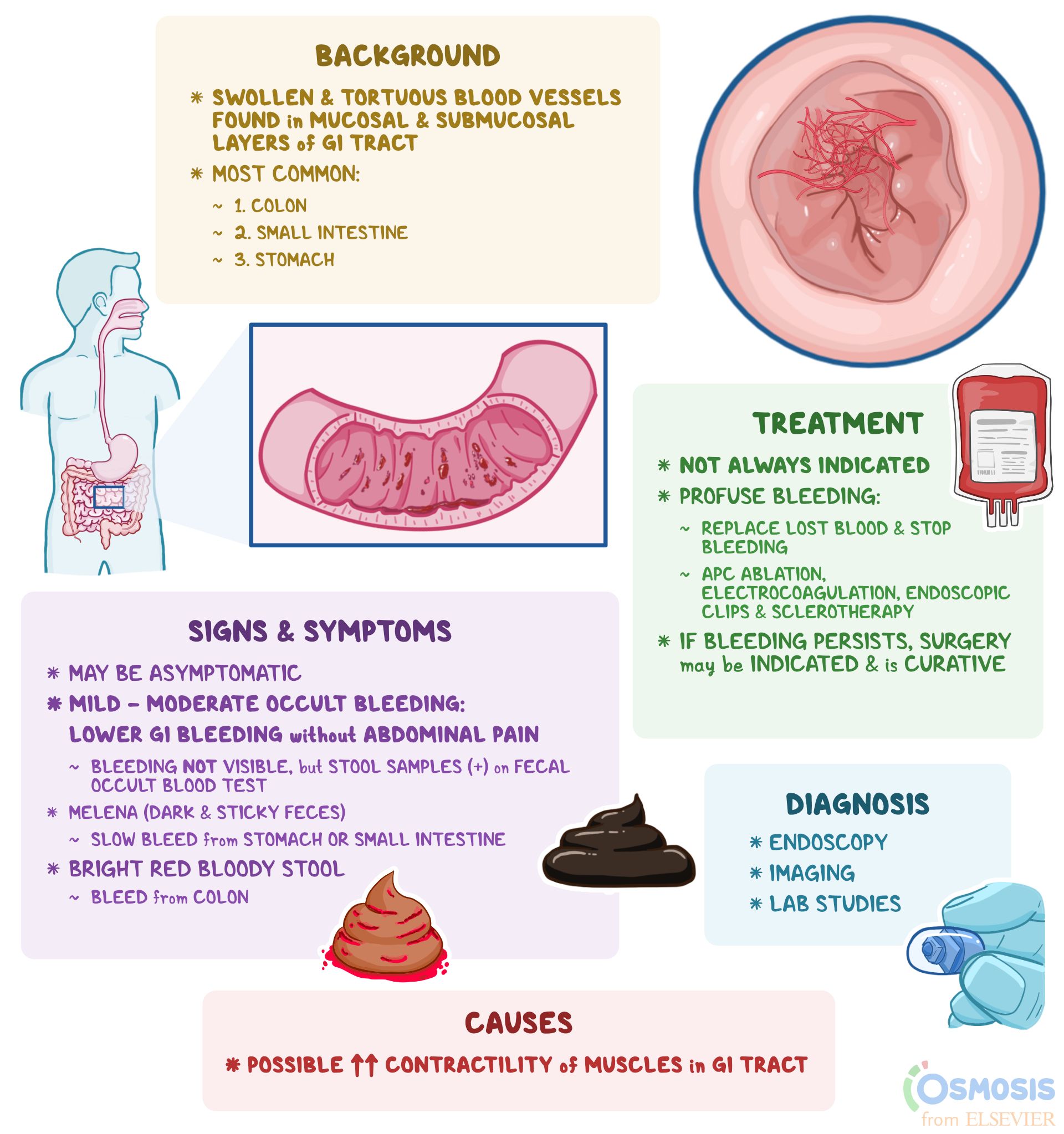 Angiodysplasia Angiodysplasia