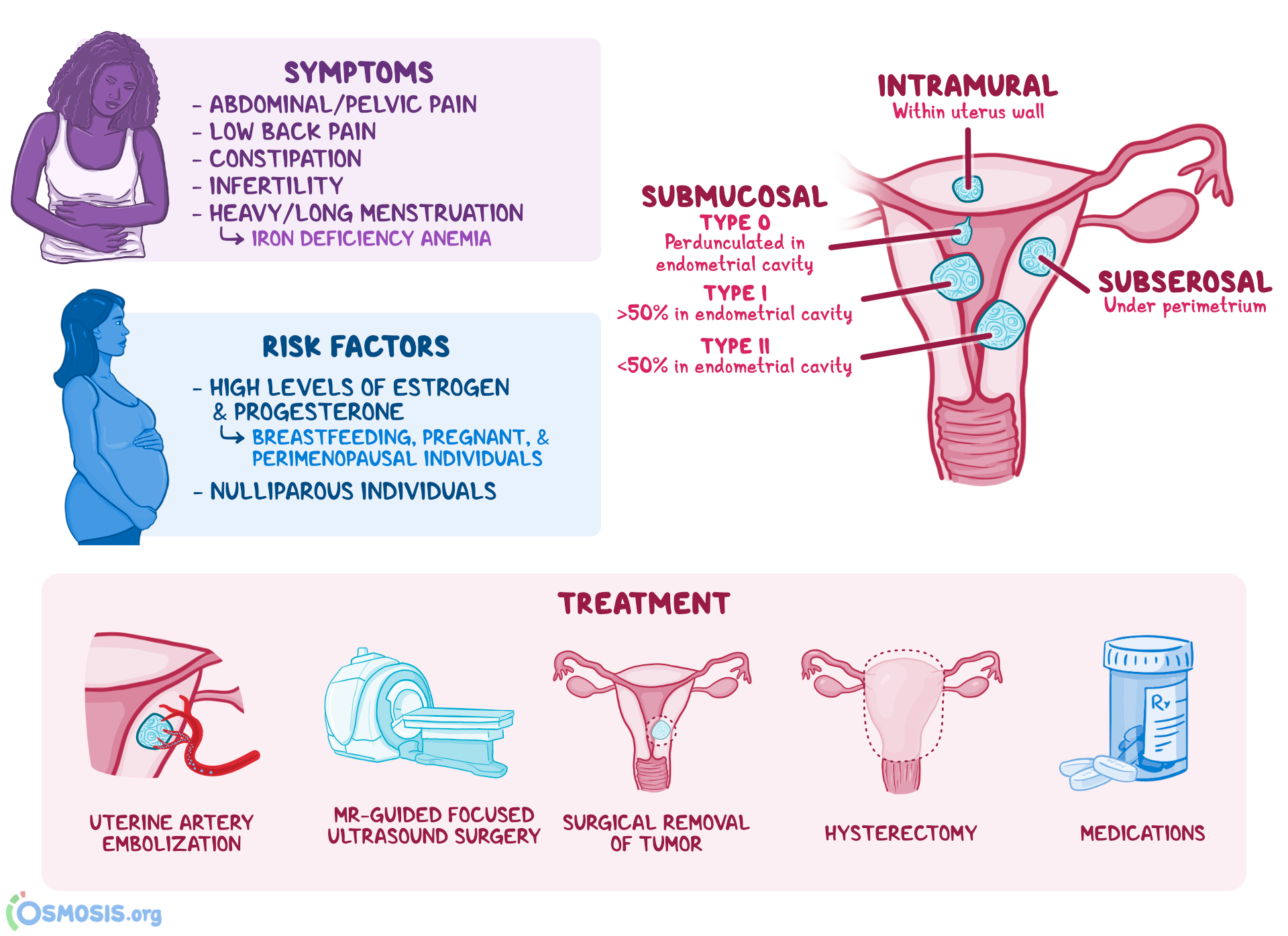 Leiomyoma Of Uterus Uterine Fibroid What Is It Causes Types Leiomyoma Of Uterus Uterine Fibroid What Is It Causes Types