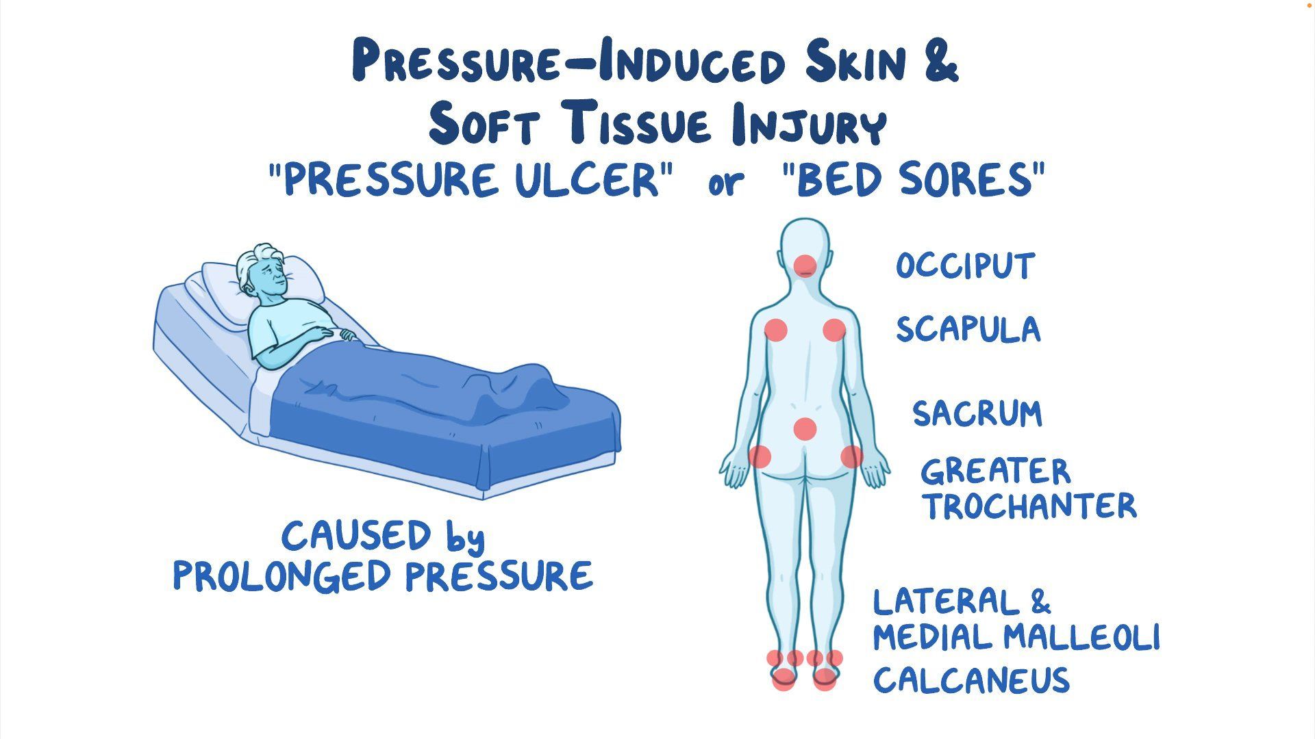 Video: Pressure-induced skin and soft tissue injury: Clinical sciences ...