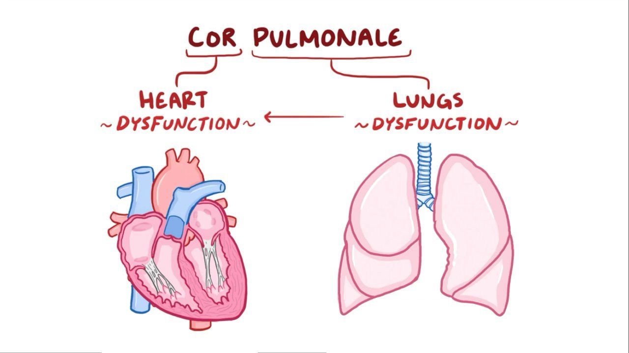Cor Pulmonale what To Know Cor Pulmonale what To Know