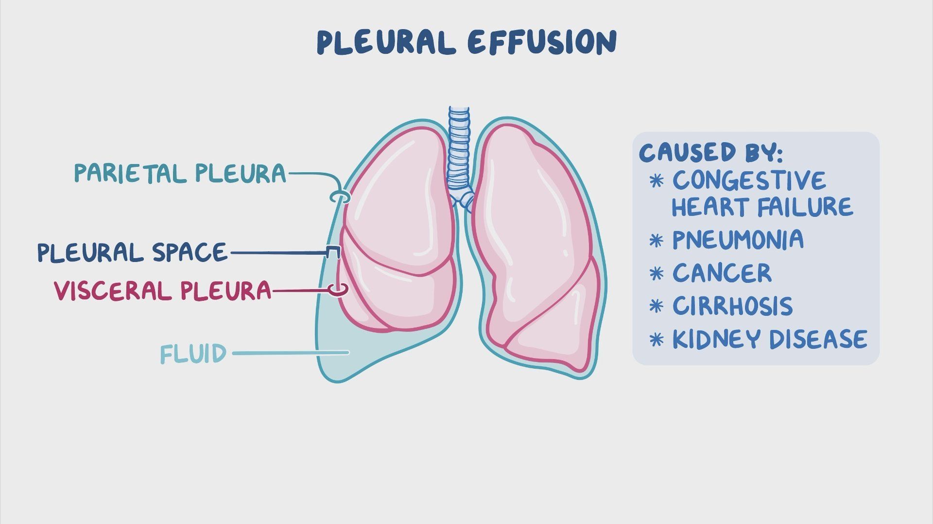 Video: Pleural effusion: Clinical sciences | Osmosis