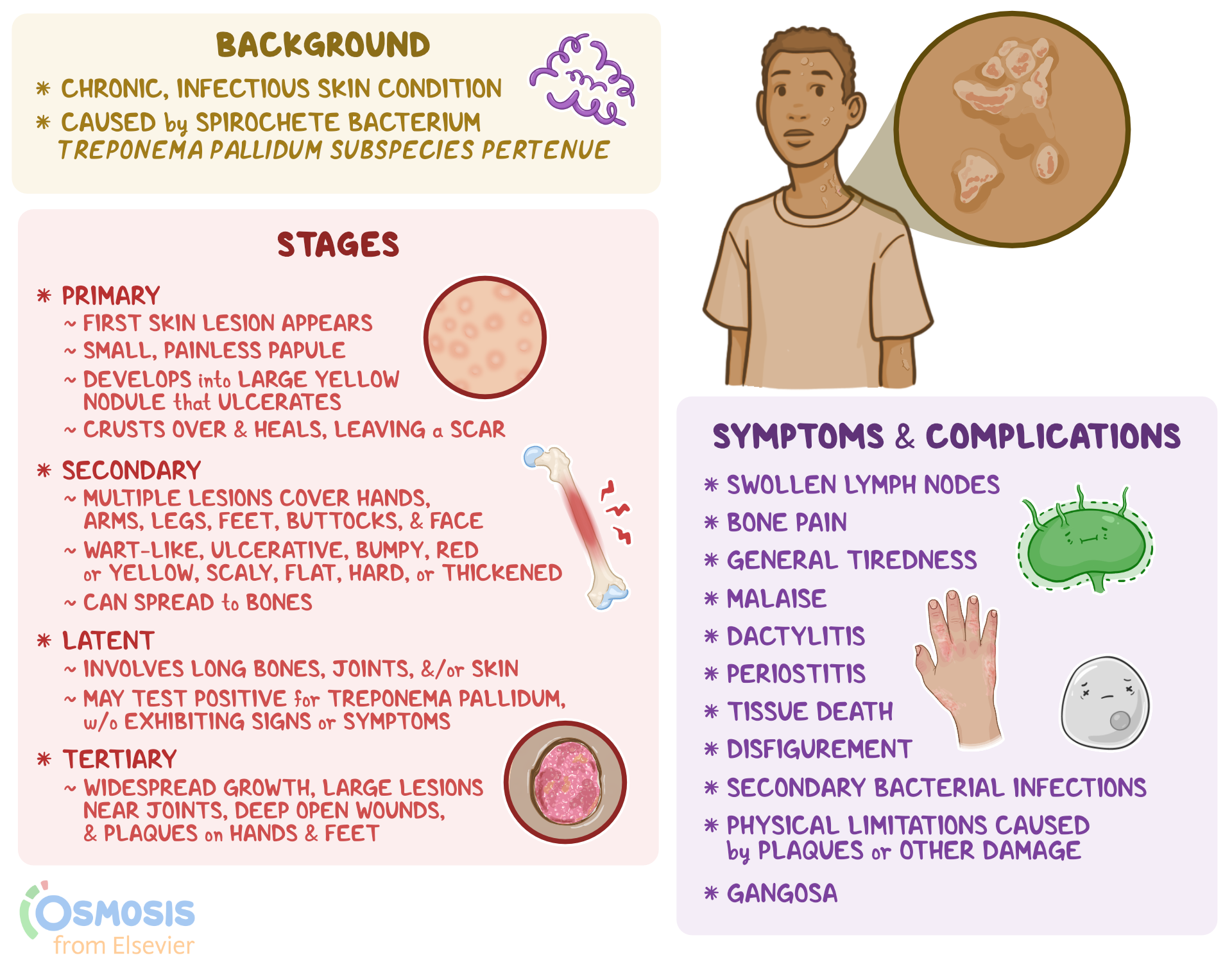 Yaws Disease: What It Is, Presentation, Treatment and More | Osmosis