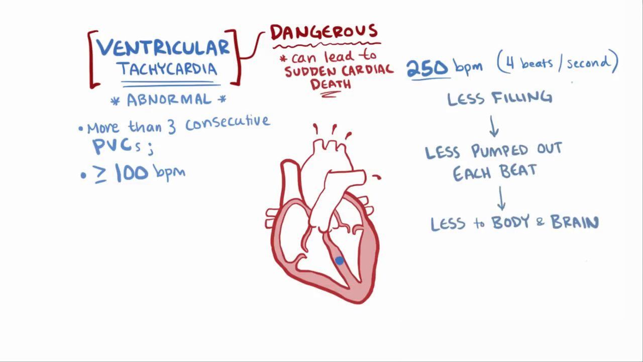 Video: Ventricular tachycardia | Osmosis