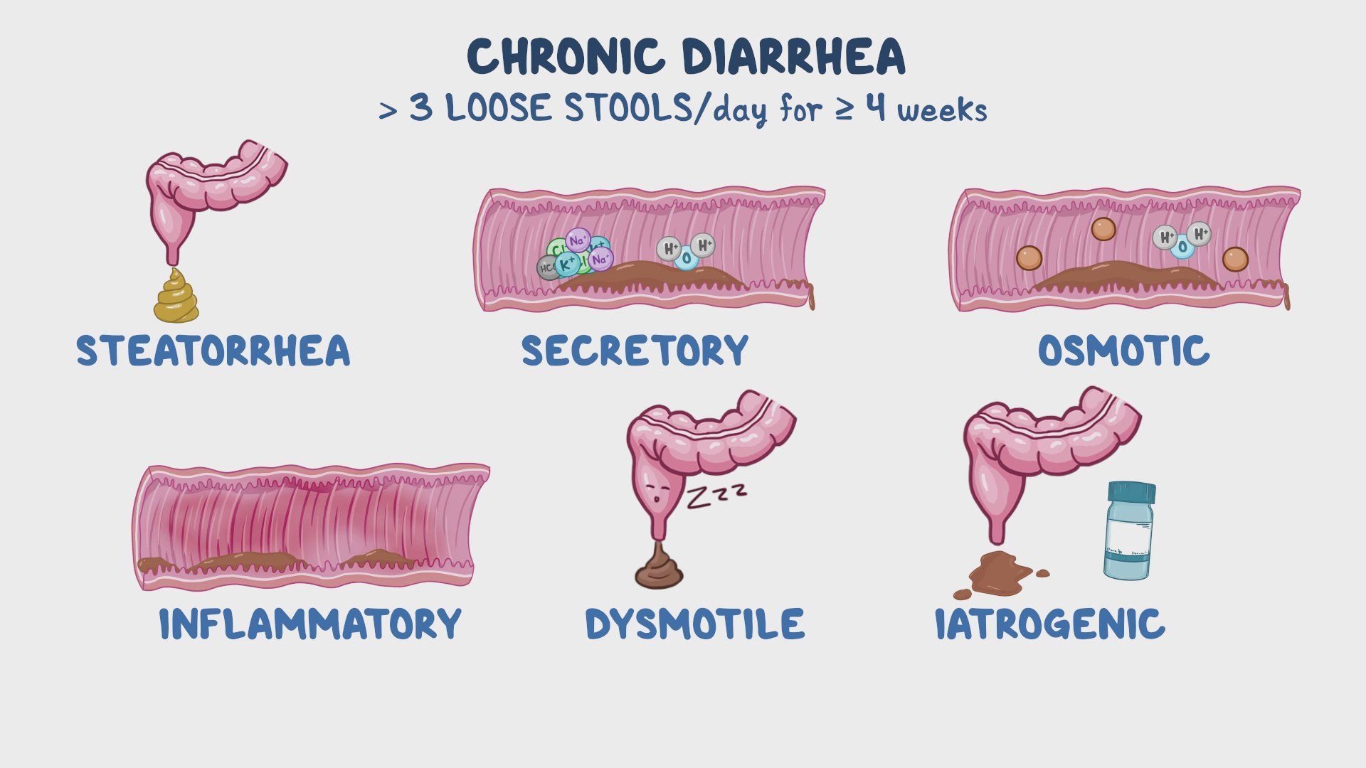 Video: Approach to diarrhea (chronic): Clinical sciences | Osmosis