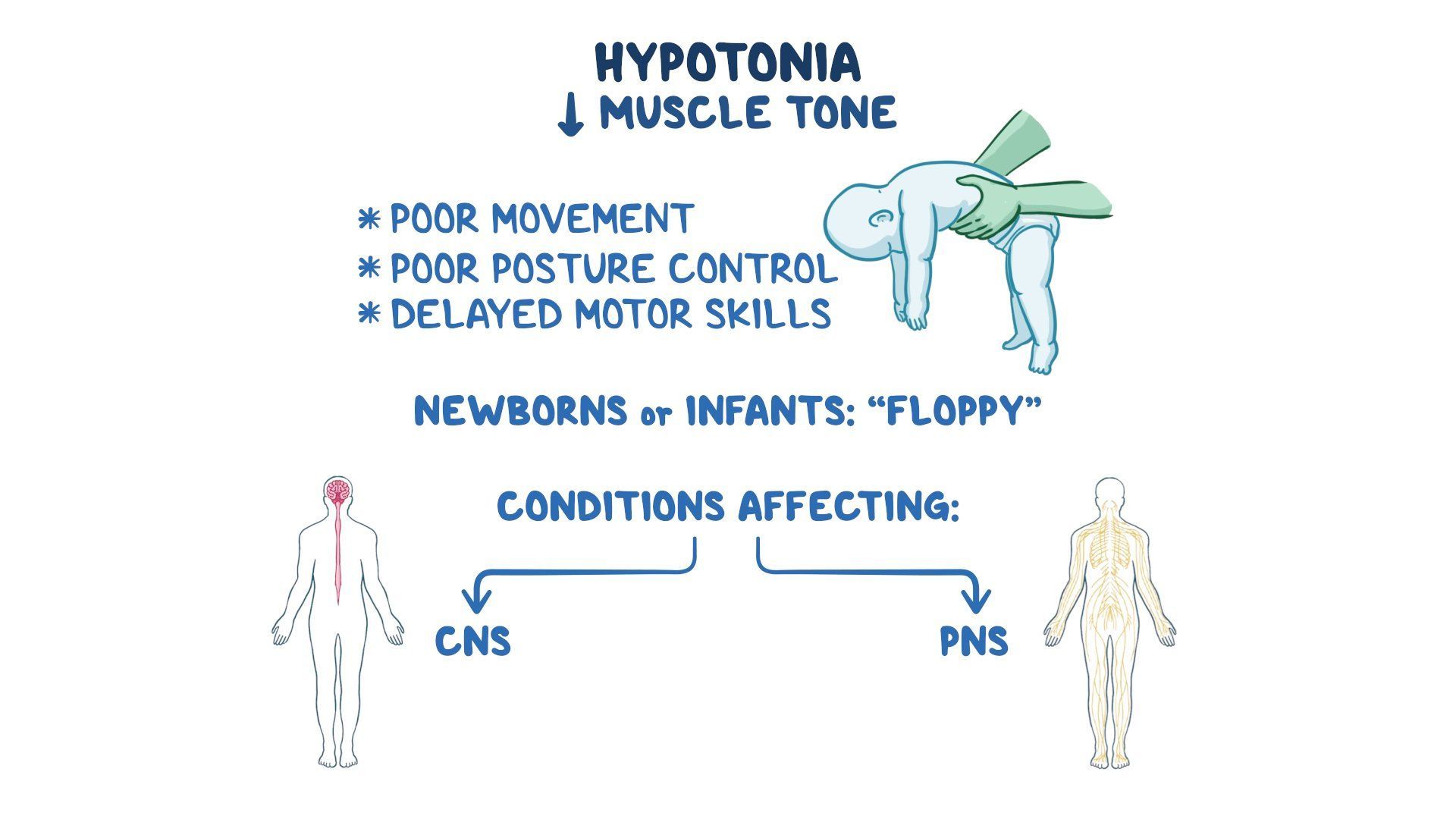 Video: Approach to hypotonia (newborn and infant): Clinical sciences ...