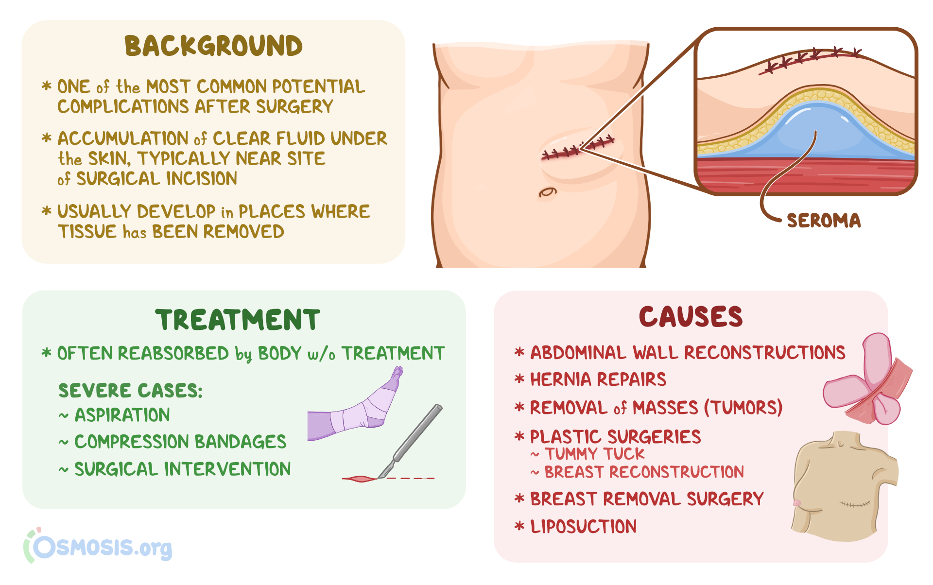 Seroma What Is It Causes Treatment And More Seroma What Is It Causes Treatment And More