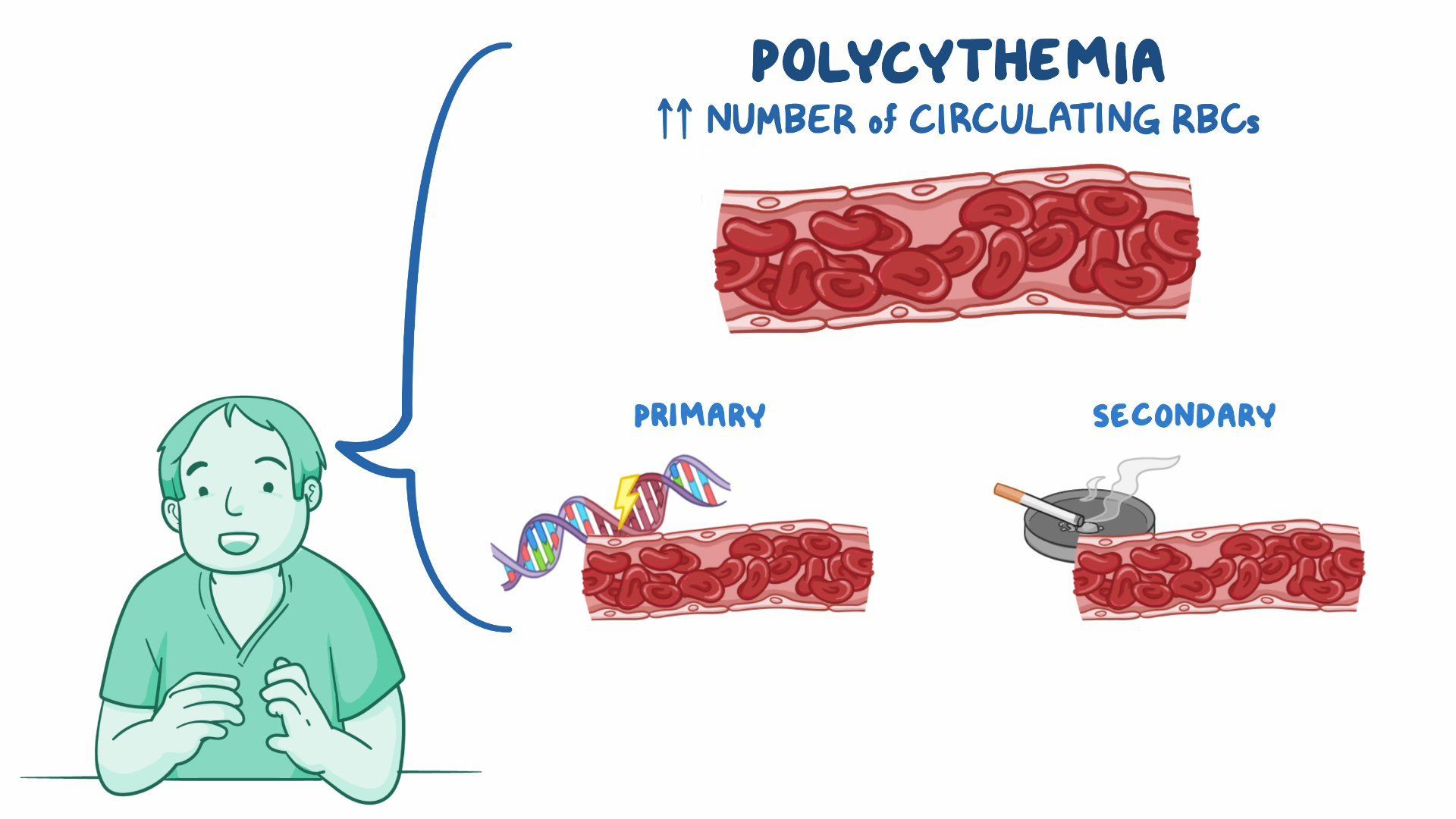 Video: Polycythemia: Nursing | Osmosis