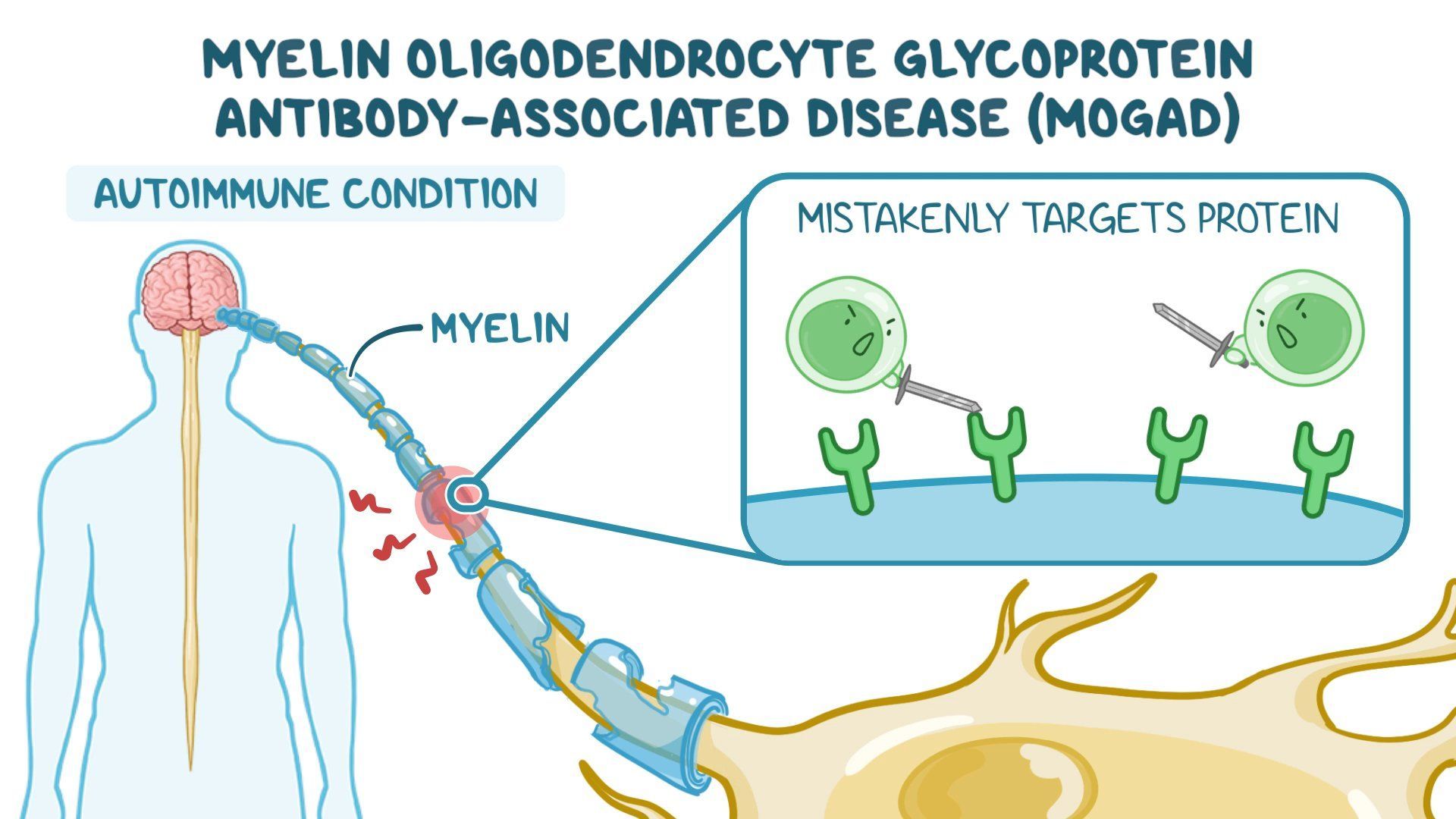 Video: Myelin oligodendrocyte glycoprotein antibody-associated disease ...