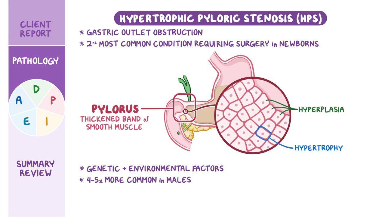 Pyloric stenosis: Nursing Process (ADPIE) - Osmosis