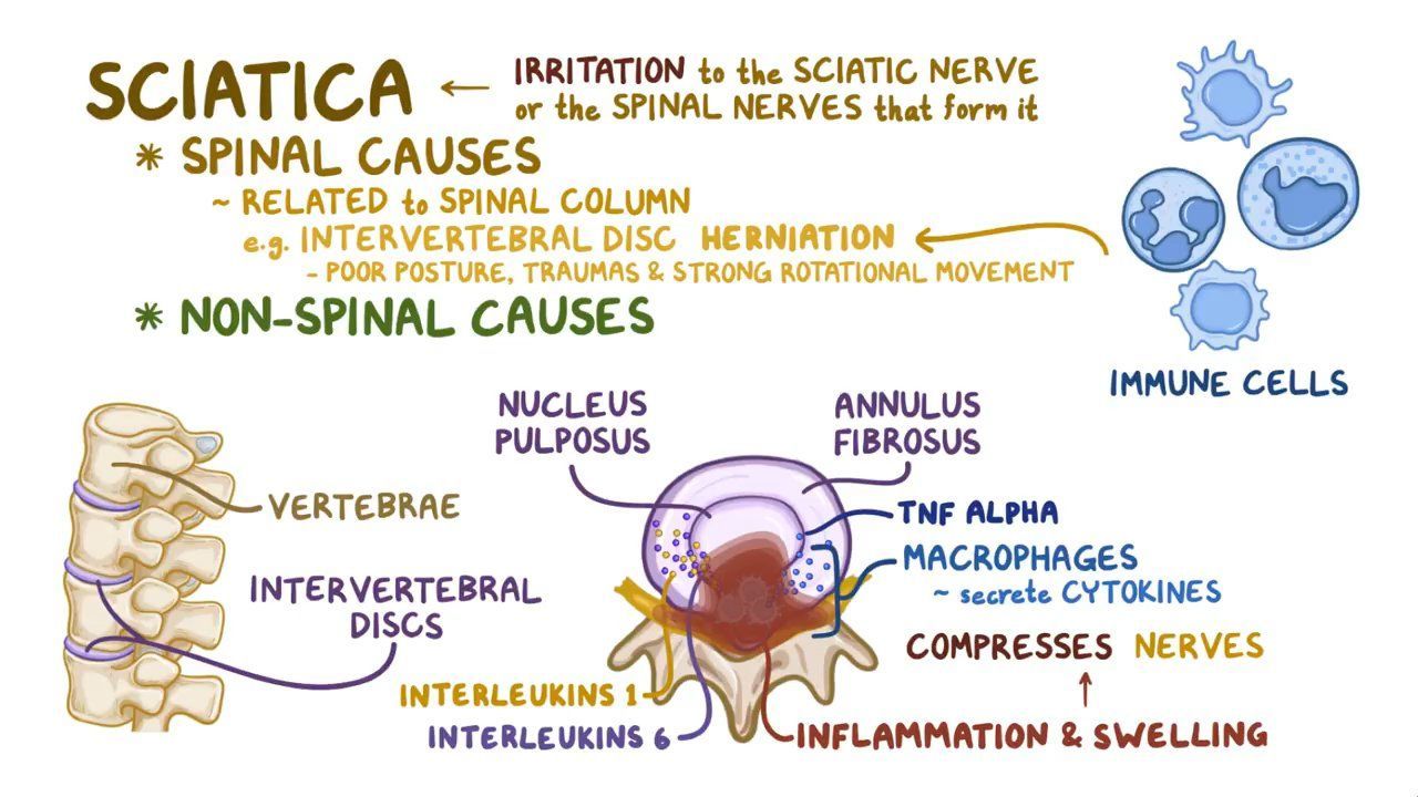 Video: Sciatica | Osmosis