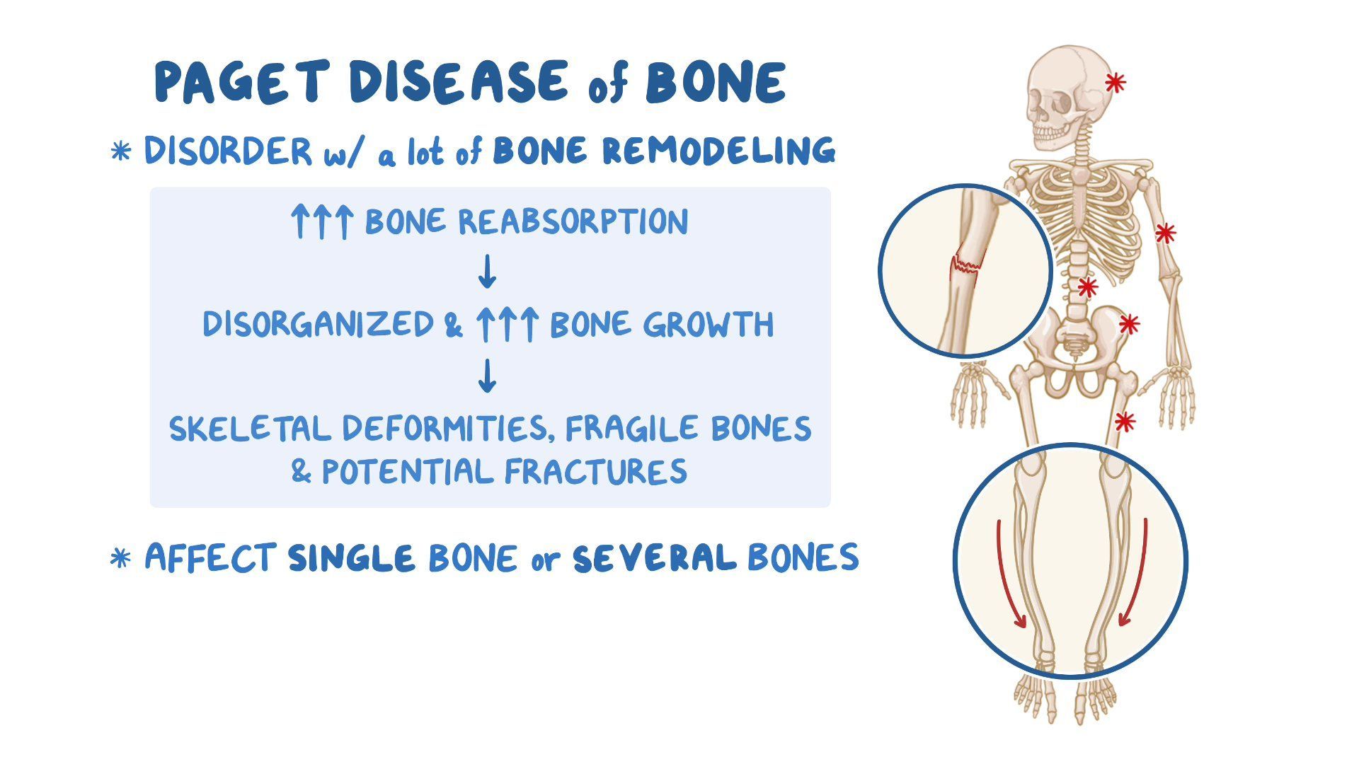 Pagets Disease