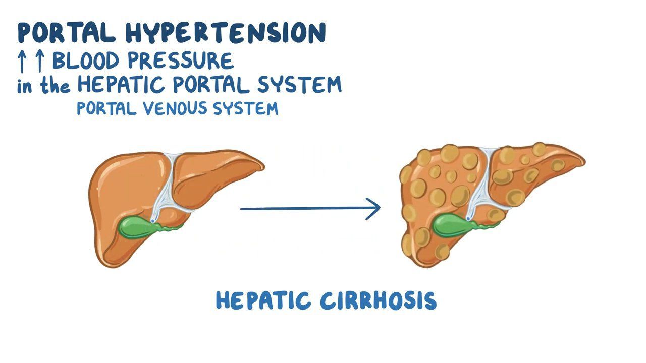 Esophageal Varices Portal Hypertension