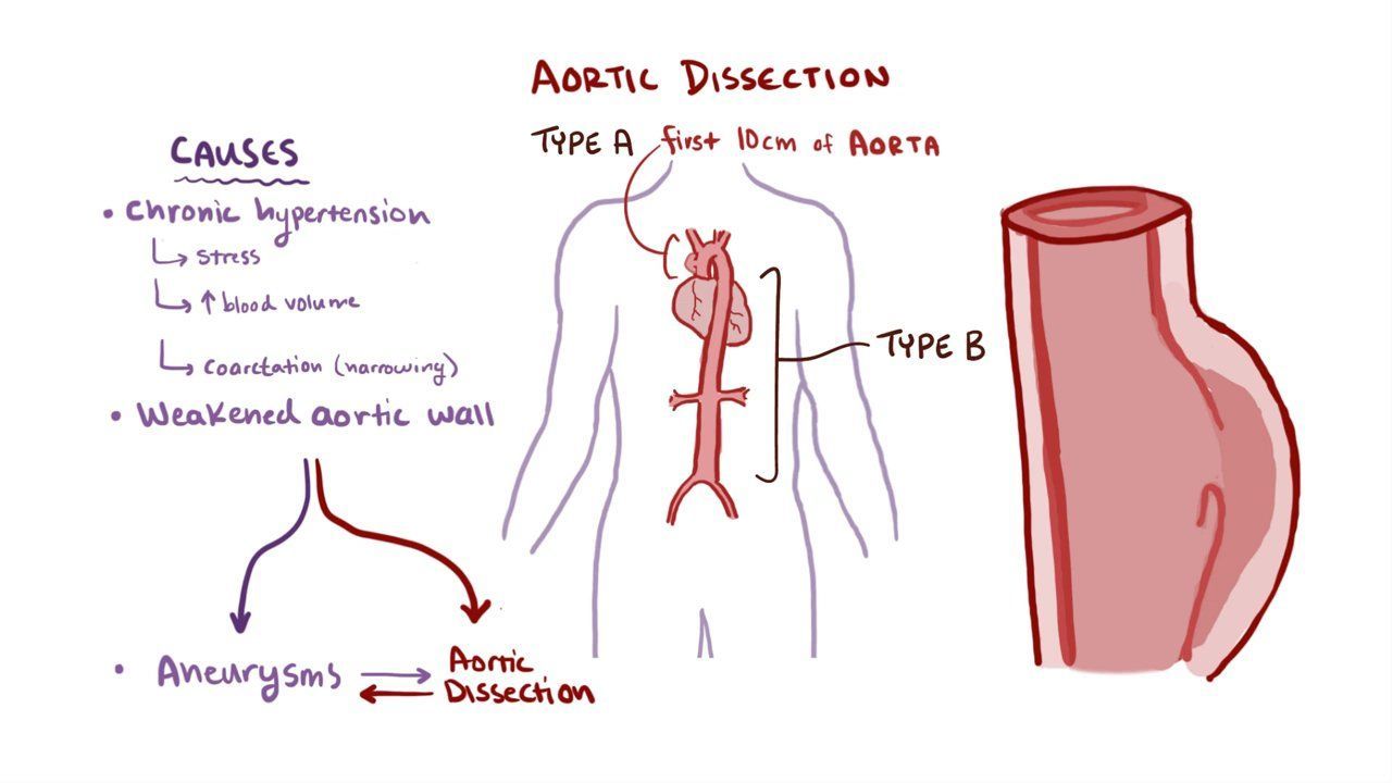 Aortic Dissection what To Know 