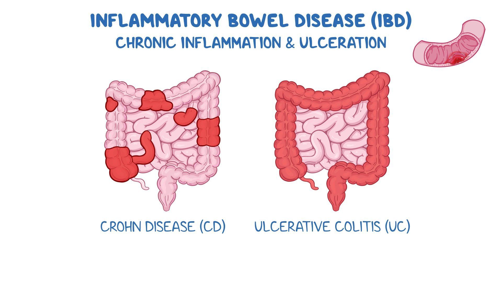 Video: Inflammatory bowel disease: Nursing pathophysiology | Osmosis