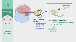 Alexithymia: What Is It, Signs, Symptoms, and More | Osmosis