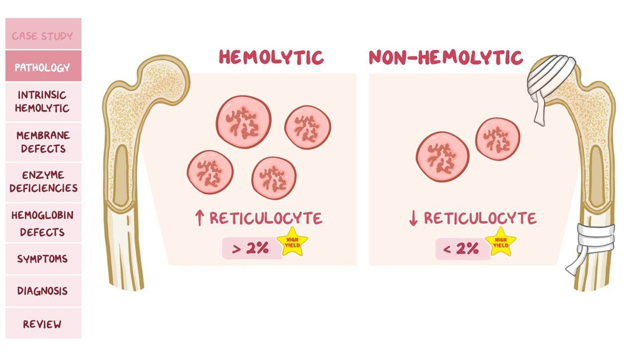 Intrinsic hemolytic normocytic anemia: Pathology review - Osmosis