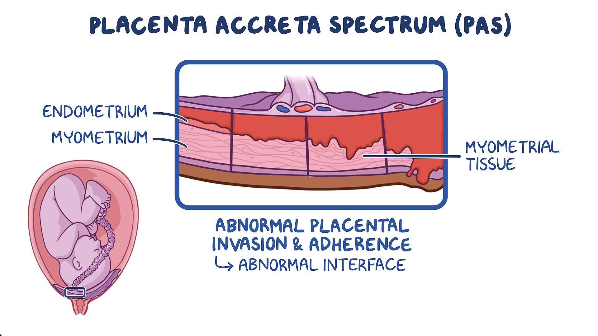 Video: Placenta accreta spectrum: Clinical sciences | Osmosis