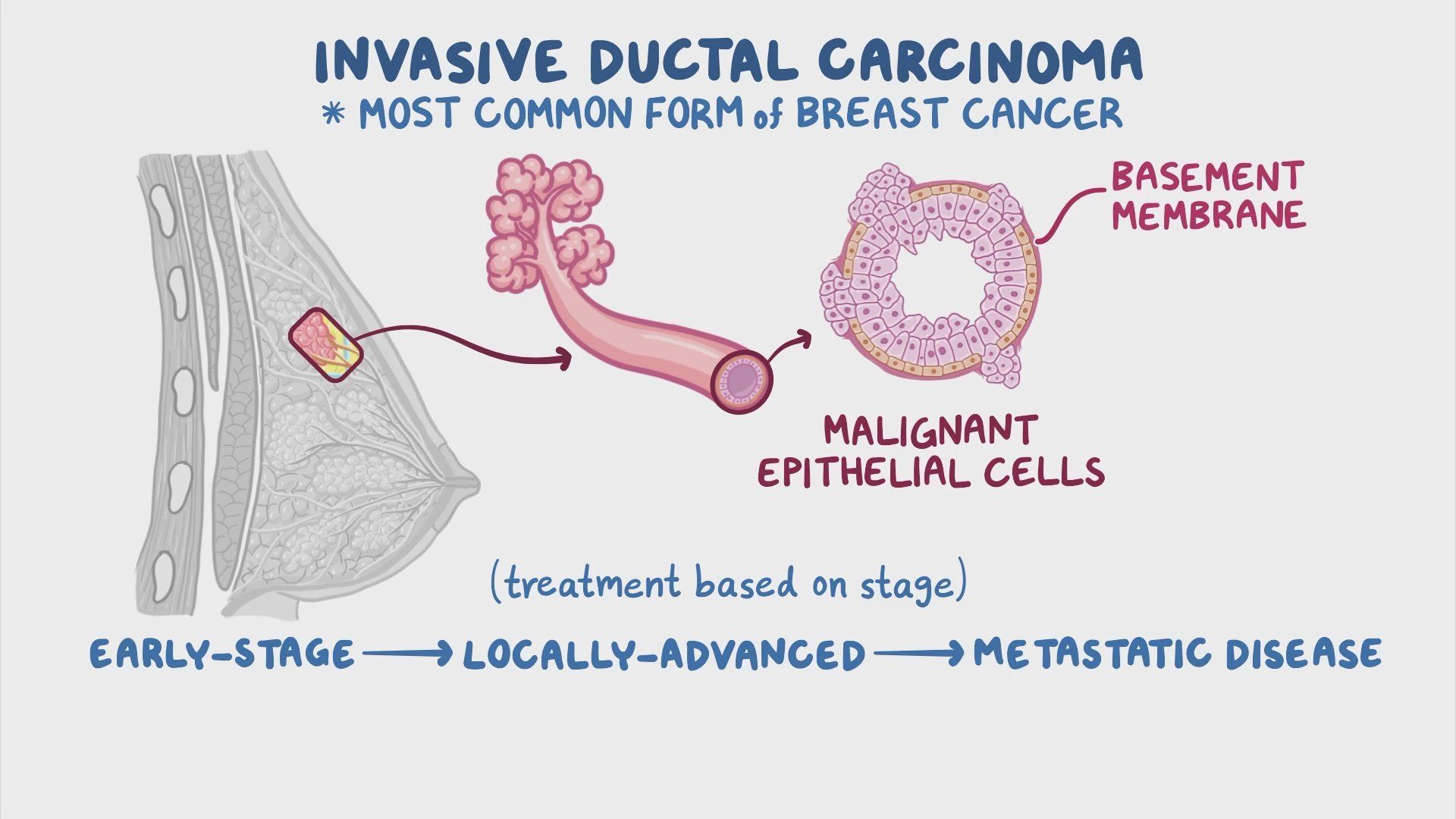 Video Invasive Ductal Carcinoma Clinical Sciences Osmosis Video Invasive Ductal Carcinoma Clinical Sciences Osmosis