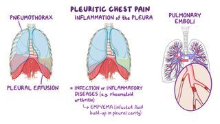 Pleurodynia: What Is It, Causes, Symptoms, and More | Osmosis