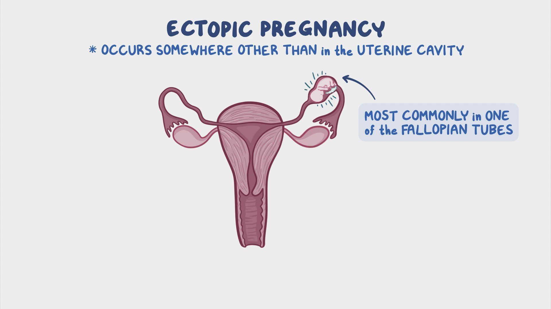 Video: Ectopic pregnancy: Nursing Video: Ectopic pregnancy: Nursing