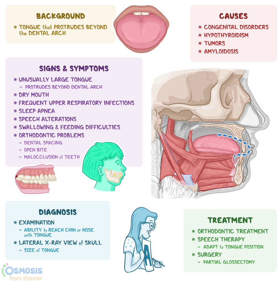 Macroglossia: What Is It, Signs and Symptoms, Treatment, and More | Osmosis