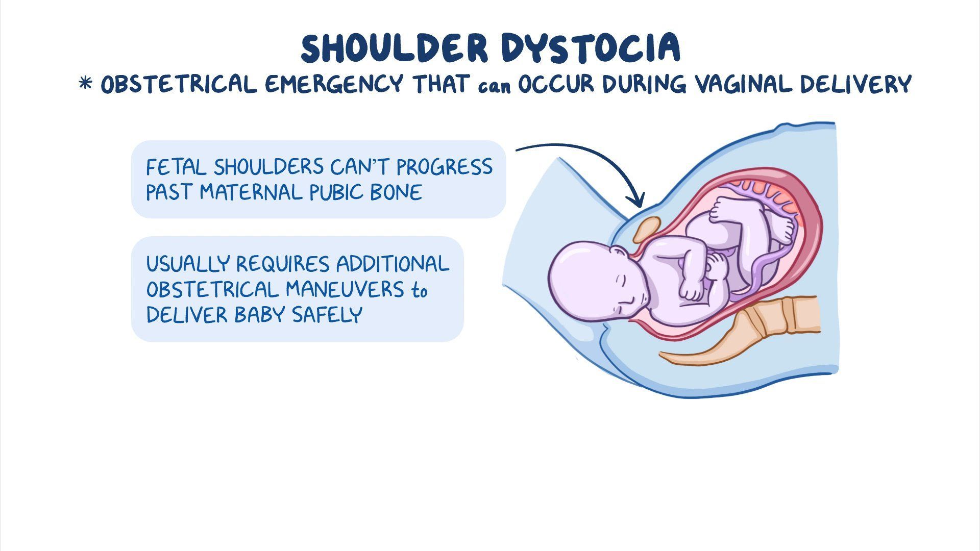 Video: Shoulder dystocia: Nursing | Osmosis