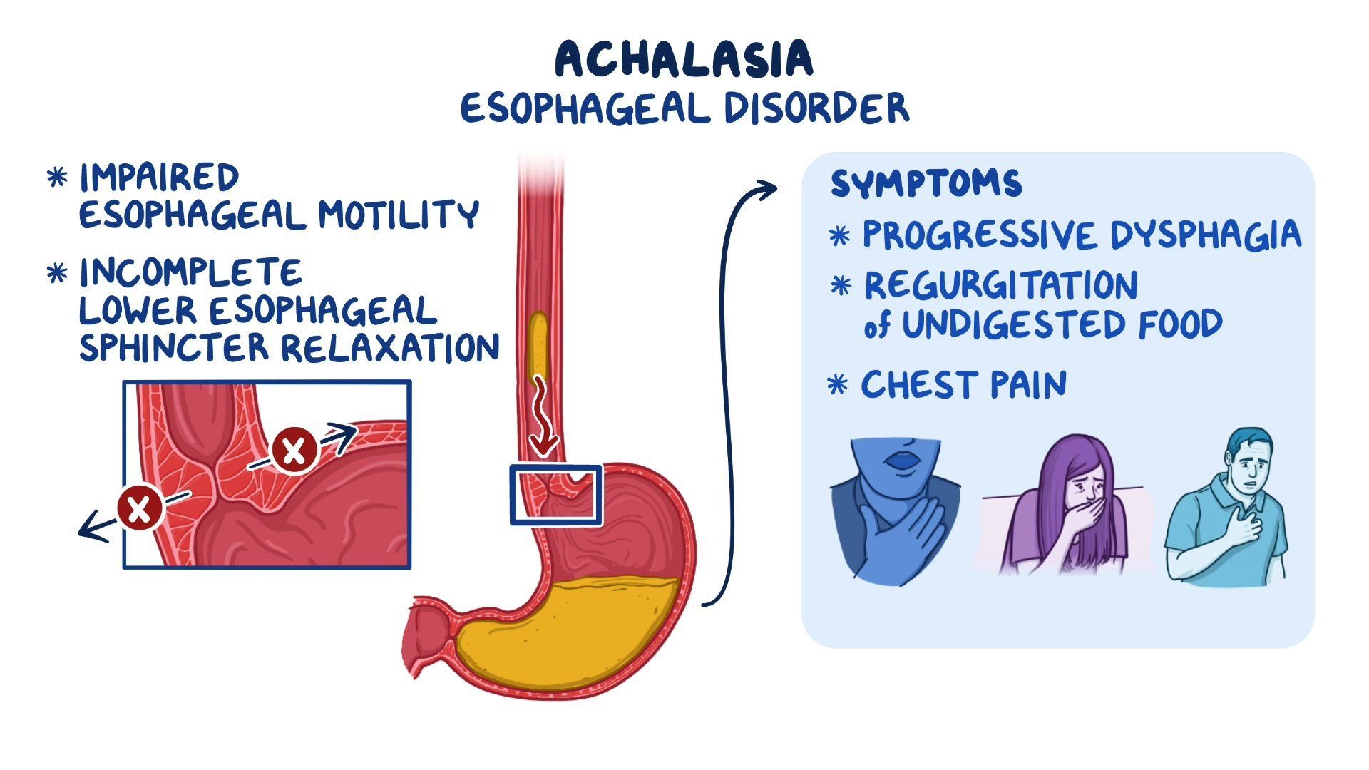 Video: Achalasia: Year of the Zebra | Osmosis