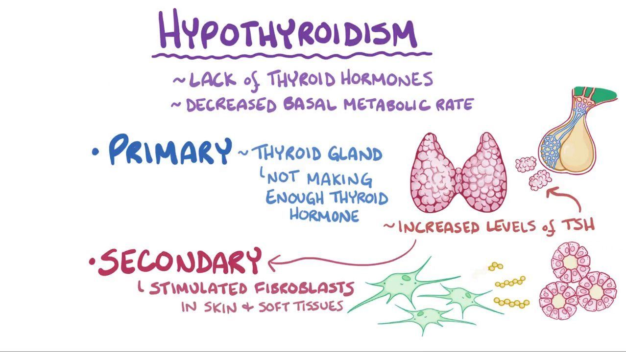 Hypothyroidism Osmosis