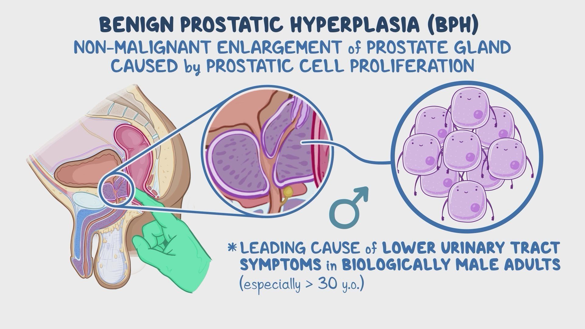 Video: Benign prostatic hypertrophy and prostate cancer: Clinical ...