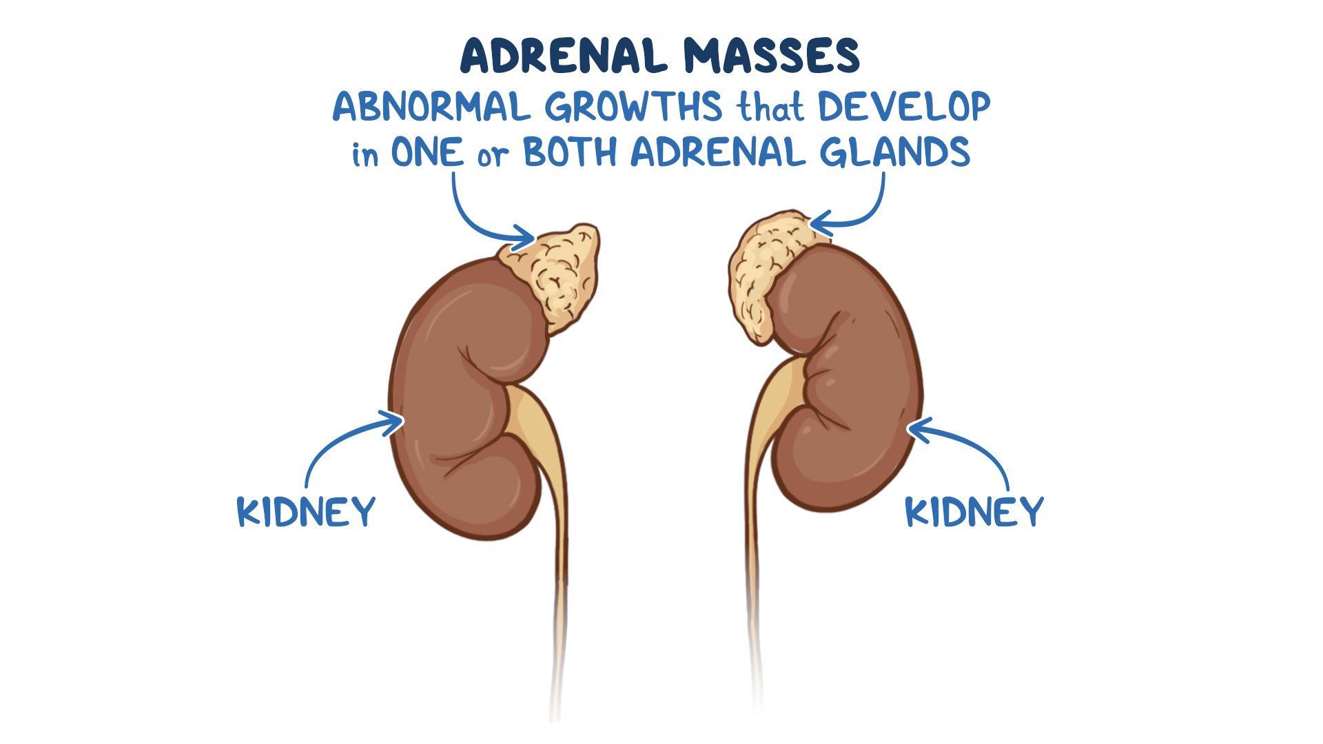 Video: Approach to adrenal masses: Clinical sciences | Osmosis