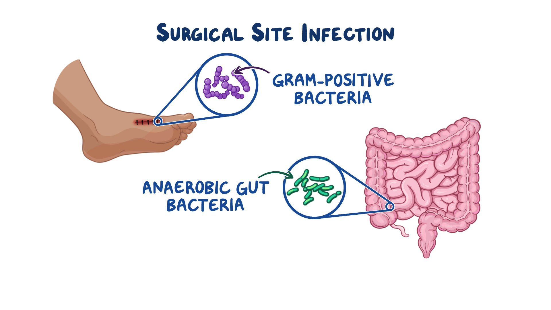 Video: Surgical site infection: Clinical sciences | Osmosis