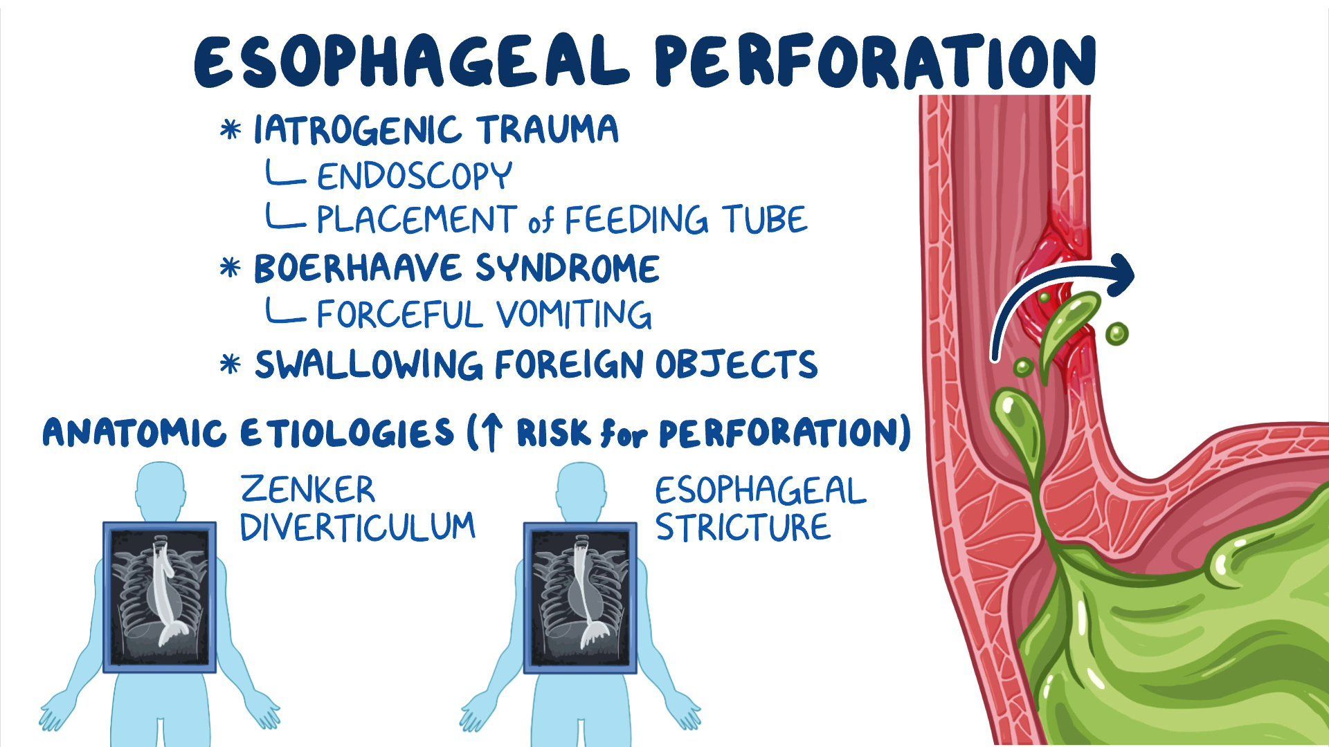 Video: Esophageal perforation: Clinical sciences | Osmosis