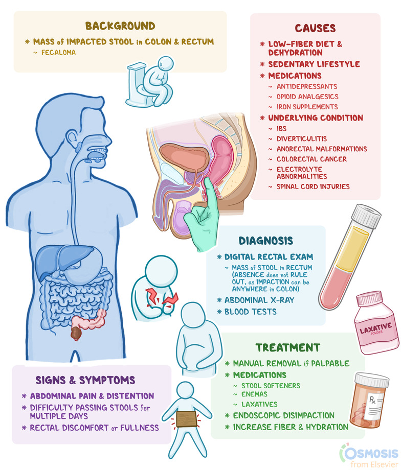 Fecal Impaction: What Is It, Causes, Treatment, and More | Osmosis