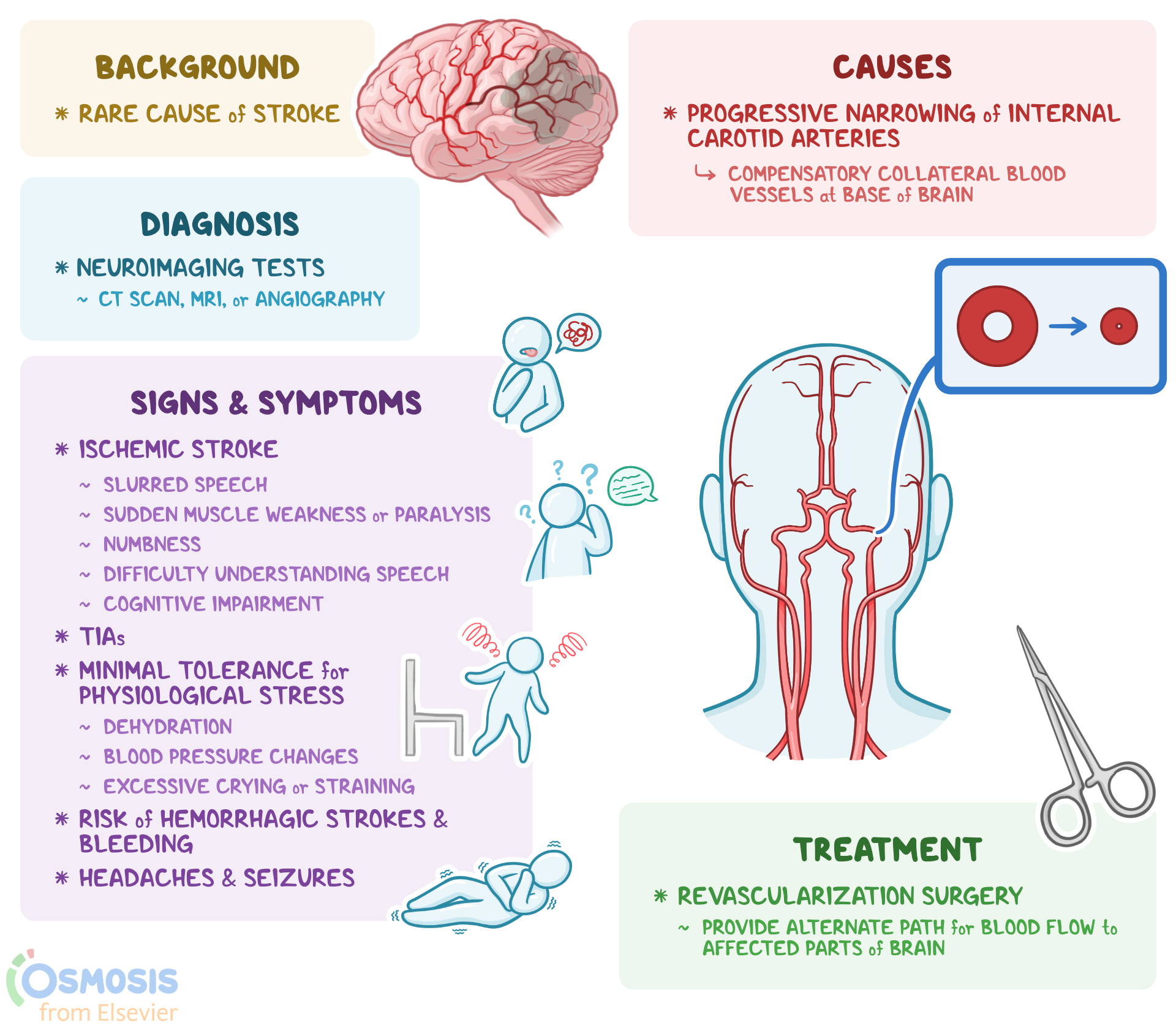 Moyamoya Disease What Is It Signs Treatment And More Moyamoya Disease What Is It Signs Treatment And More