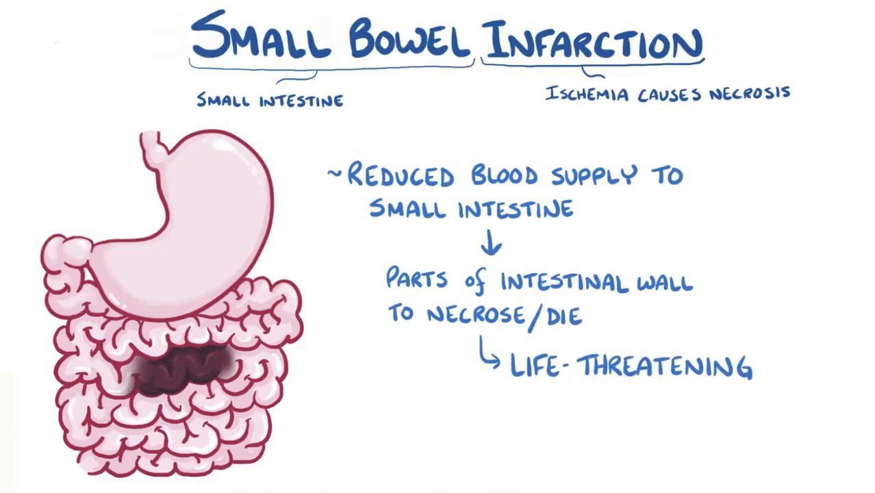 Video: Small bowel ischemia and infarction