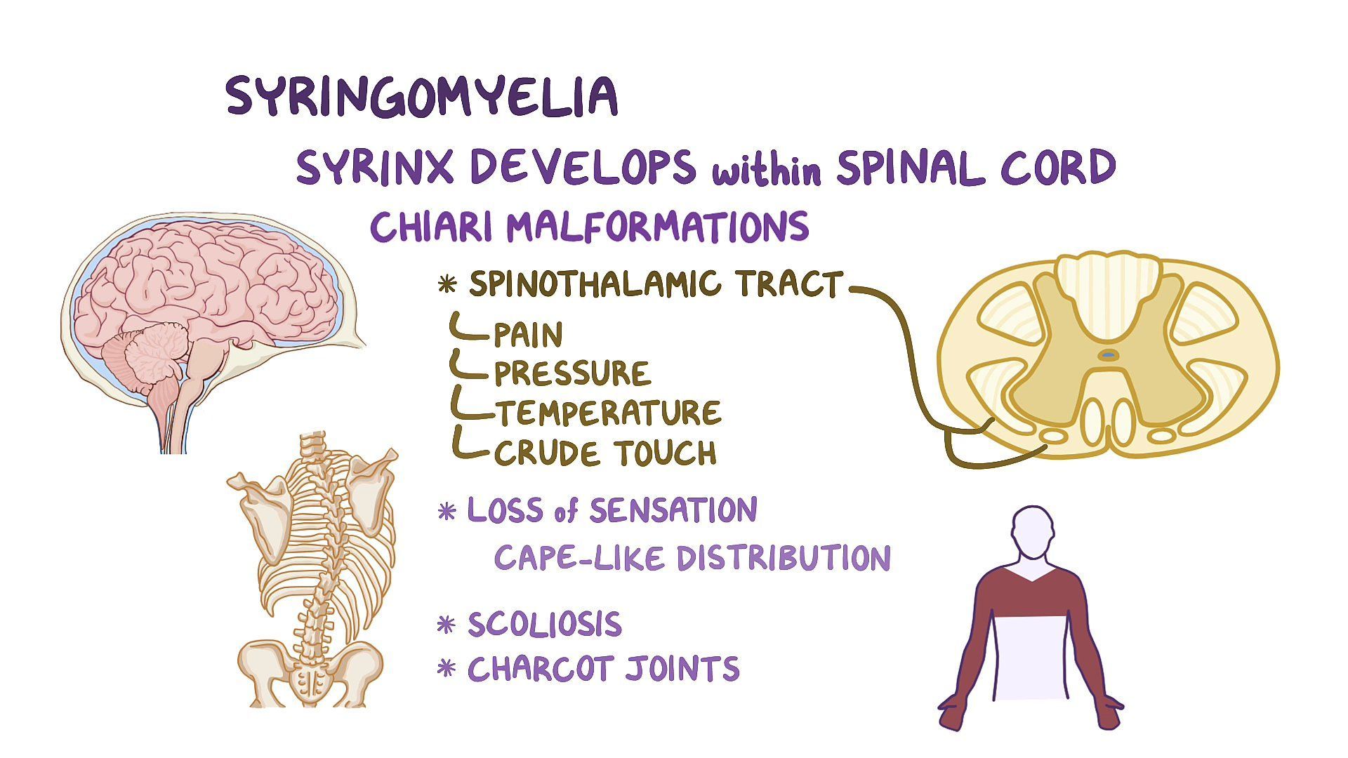 Syringomyelia Cape Like