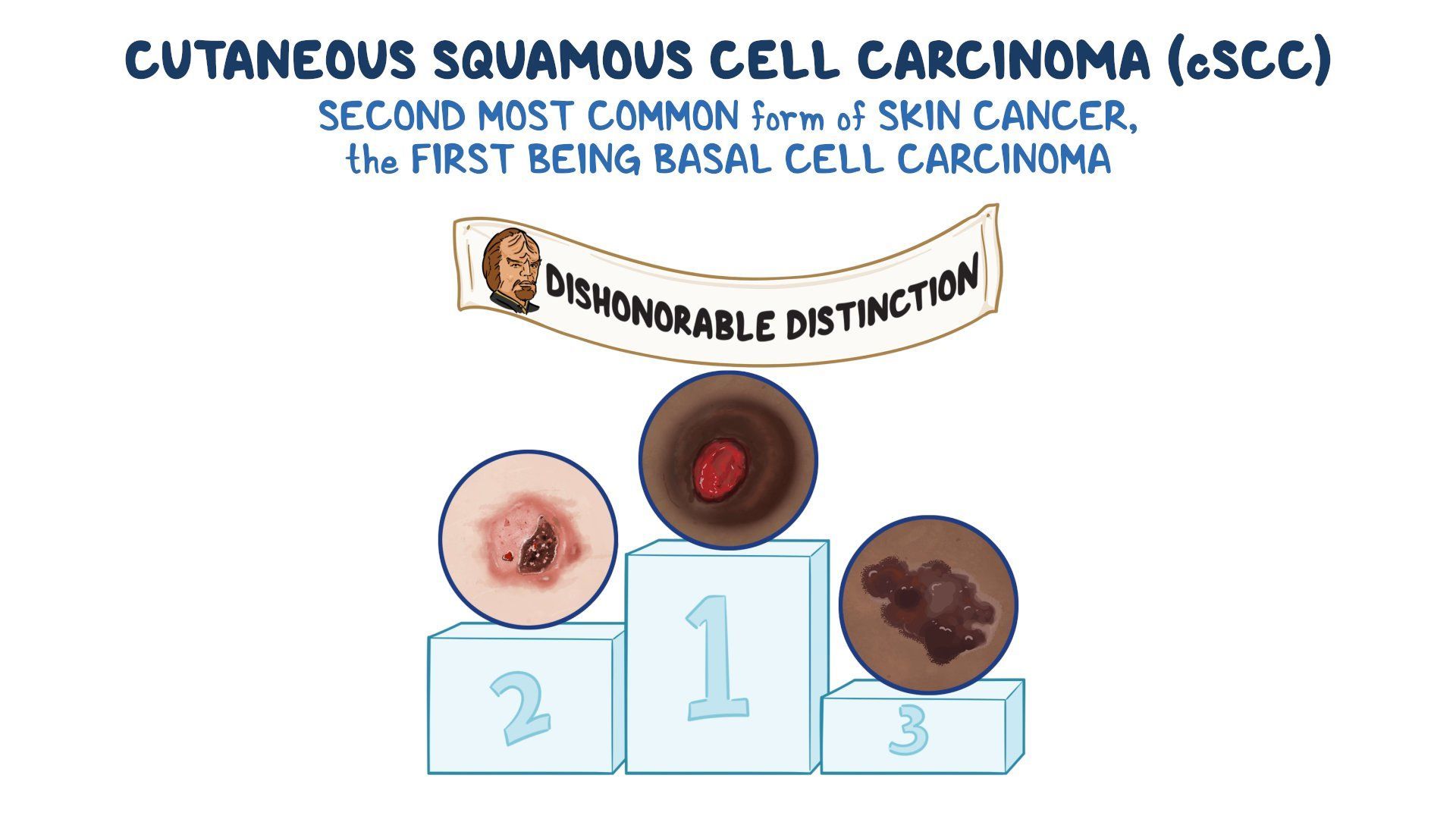 Video: Cutaneous squamous cell carcinoma: Clinical sciences | Osmosis