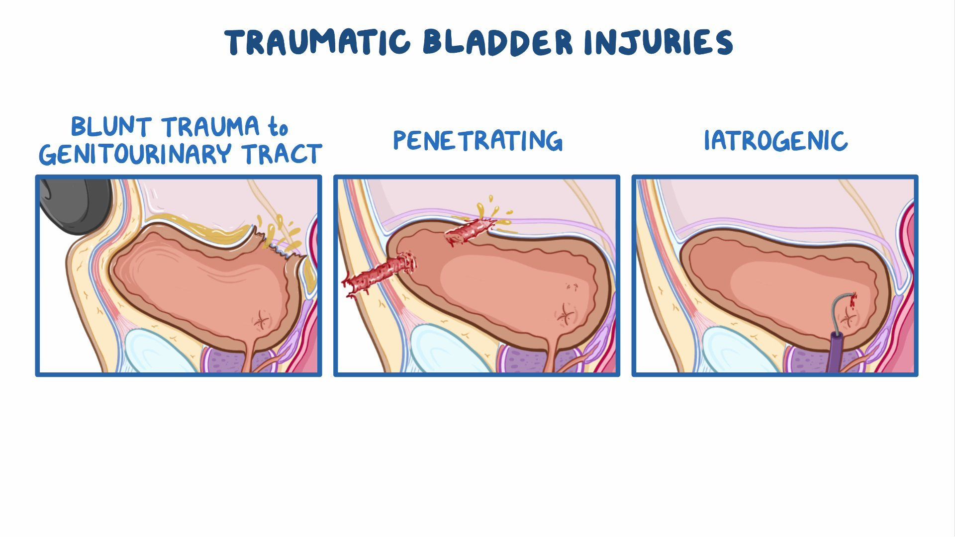 Video Bladder Injury Clinical Sciences Osmosis Video Bladder Injury Clinical Sciences Osmosis