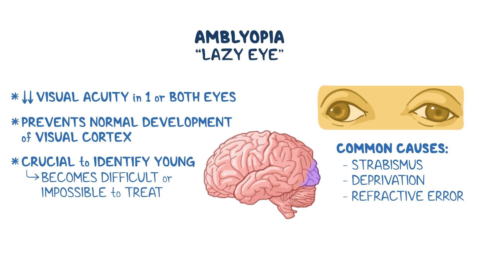 Video: Approach to amblyopia and strabismus (pediatrics): Clinical ...