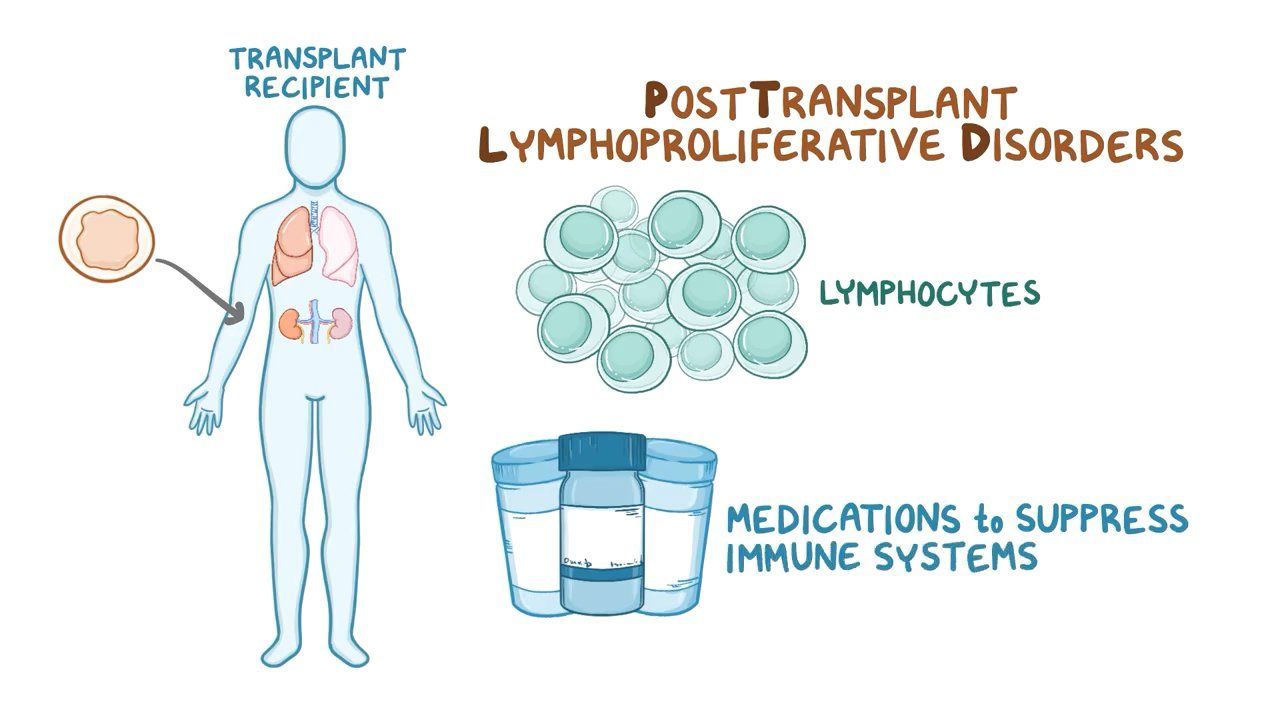 Video: Post-transplant lymphoproliferative disorders (NORD) | Osmosis