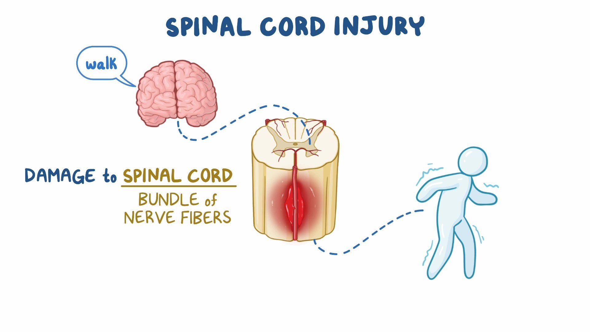 Video: Spinal cord injuries: Nursing | Osmosis