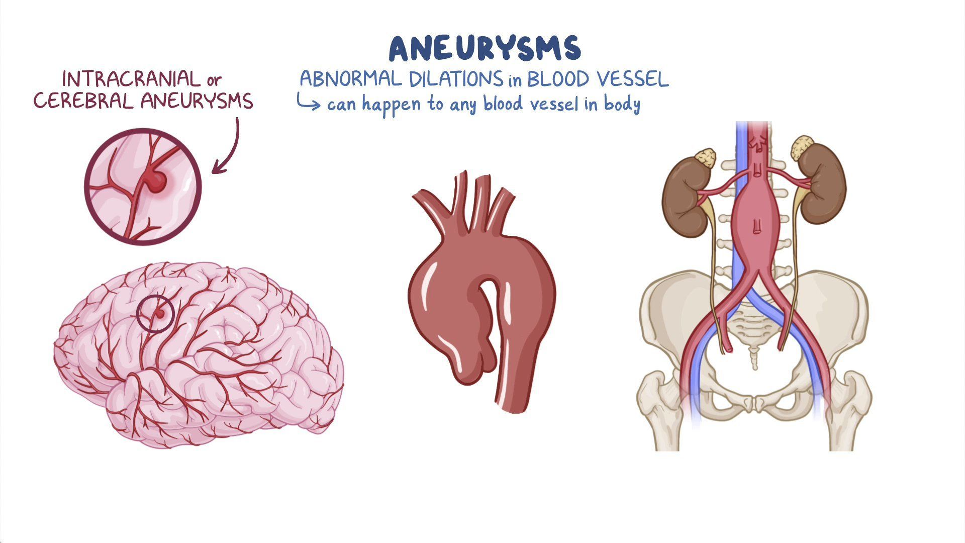 Video: Intracranial aneurysm: Nursing | Osmosis