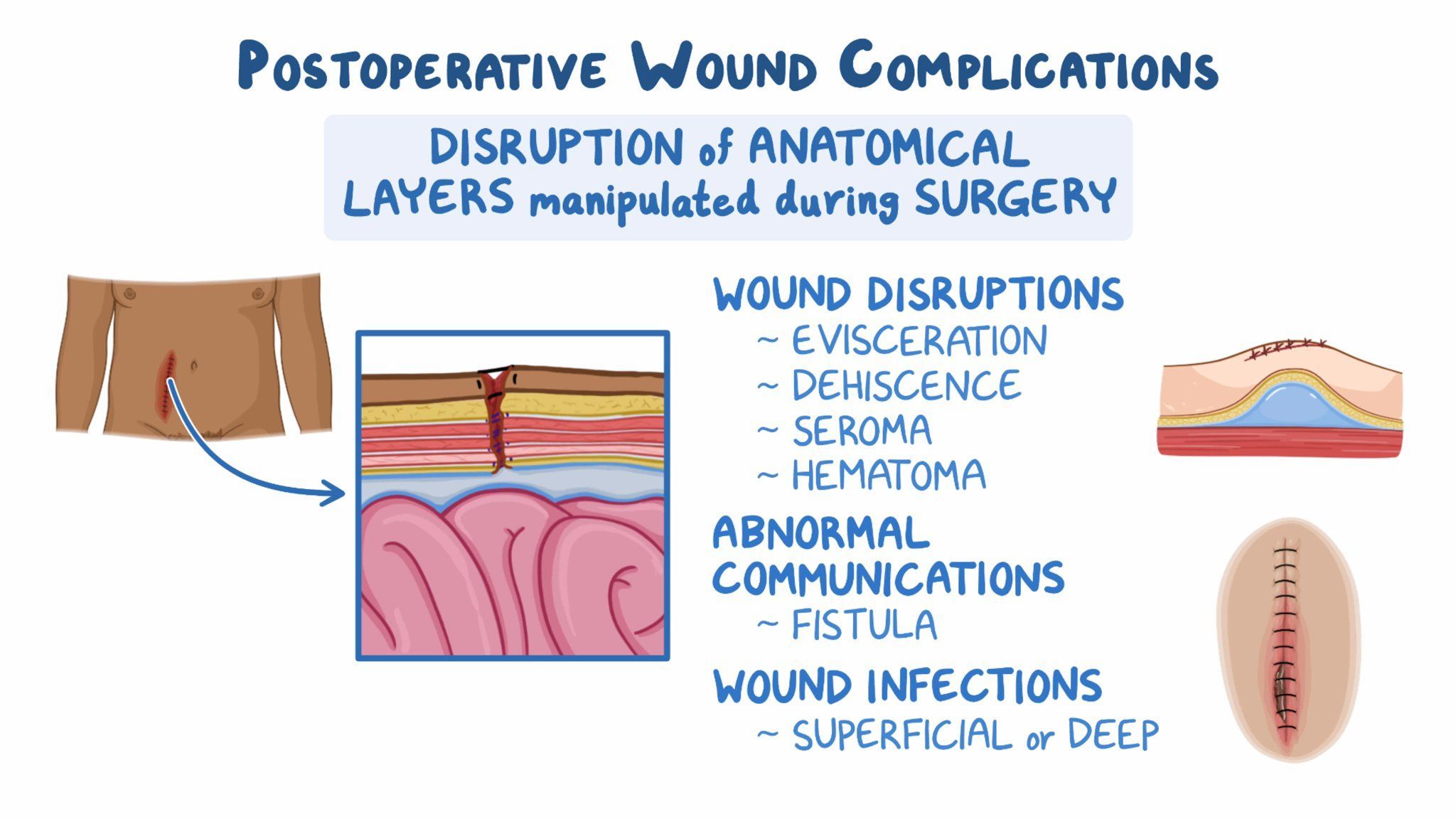 Video Approach To Postoperative Wound Complications Clinical Sciences Video Approach To Postoperative Wound Complications Clinical Sciences