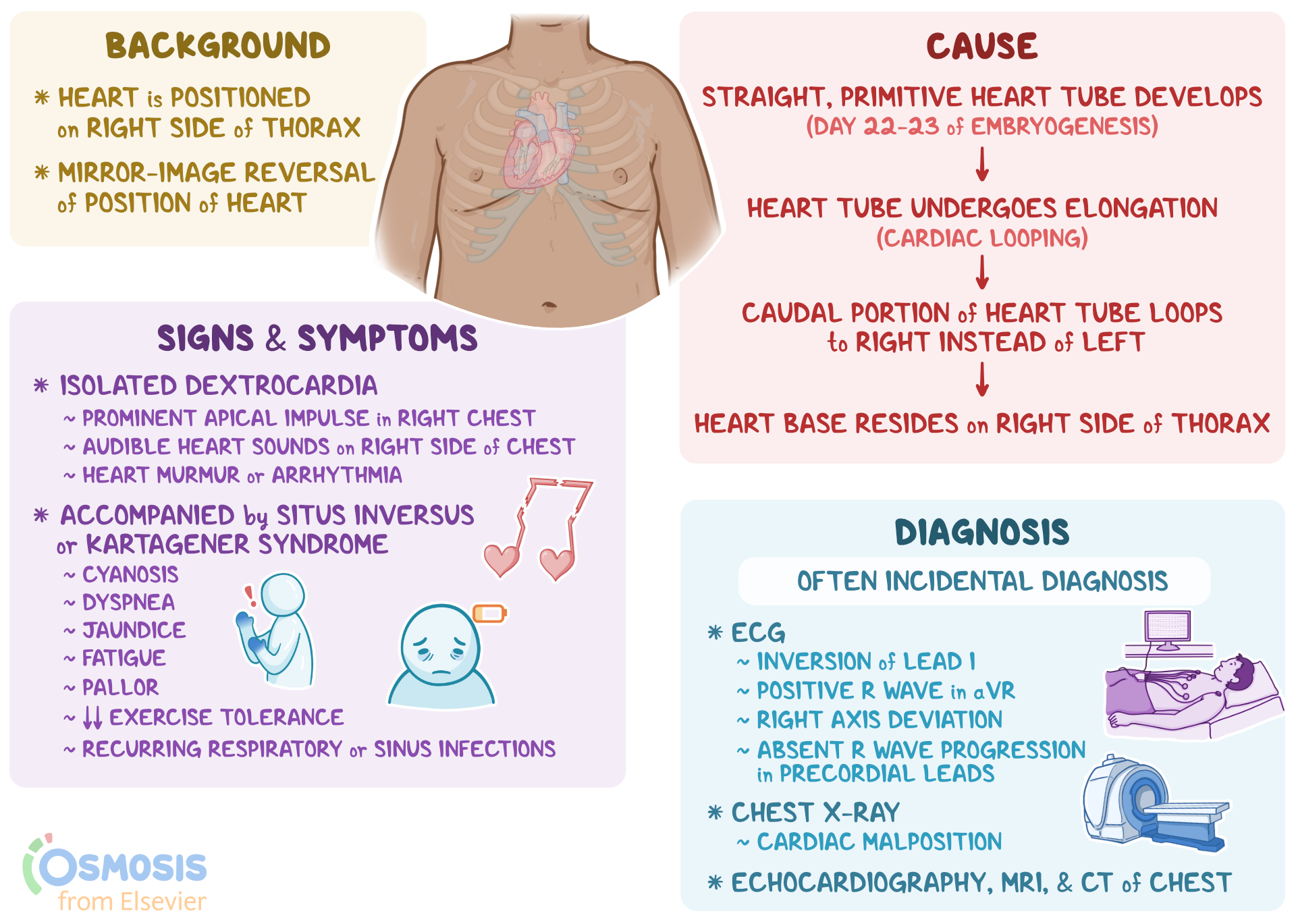 Dextrocardia: What Is It, Diagnosis, Treatment, and More | Osmosis