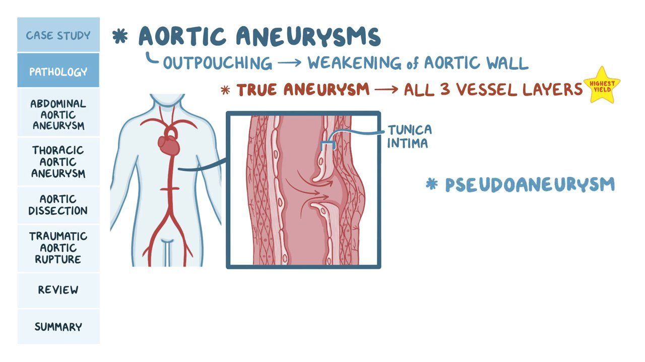 Video Aortic Dissections And Aneurysms Pathology Review