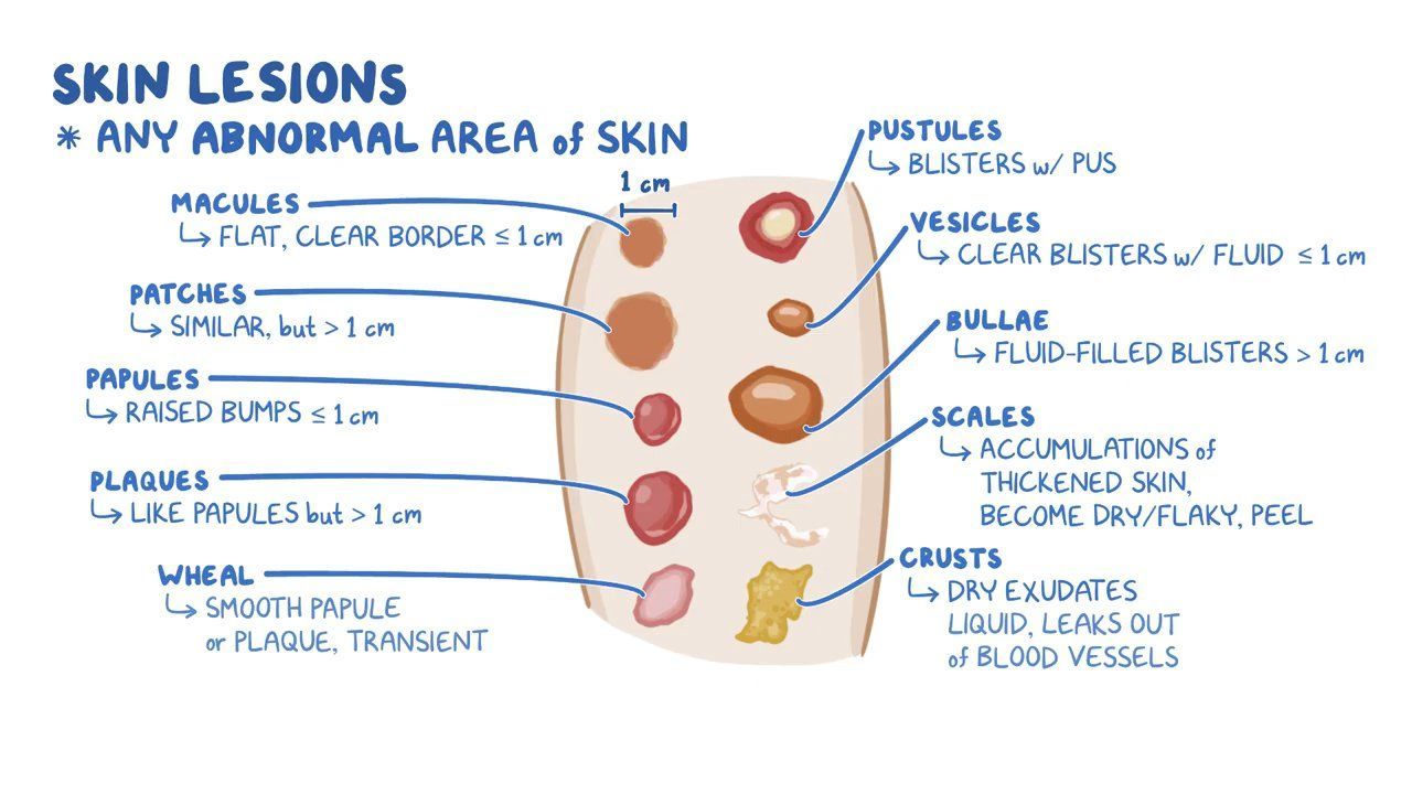 Pustule What Is It Causes Diagnosis Treatment And More Osmosis Pustule What Is It Causes Diagnosis Treatment And More Osmosis